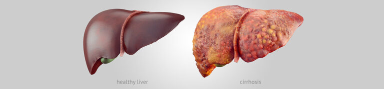 Ciroza hepatica - simptome, cauze, remedii si tratament - Ayurmed